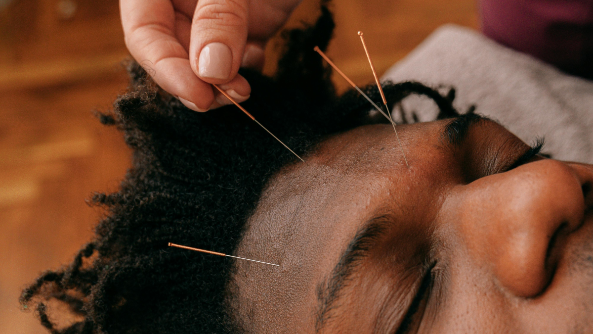 Facial acupuncture: complete guide to benefits, how it works & what to ...